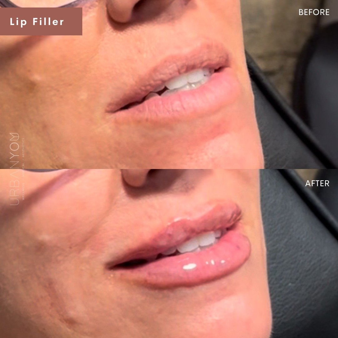 Russian Lips Cost Side Effects Before And After More — Urban You Modern Beauty Wellness