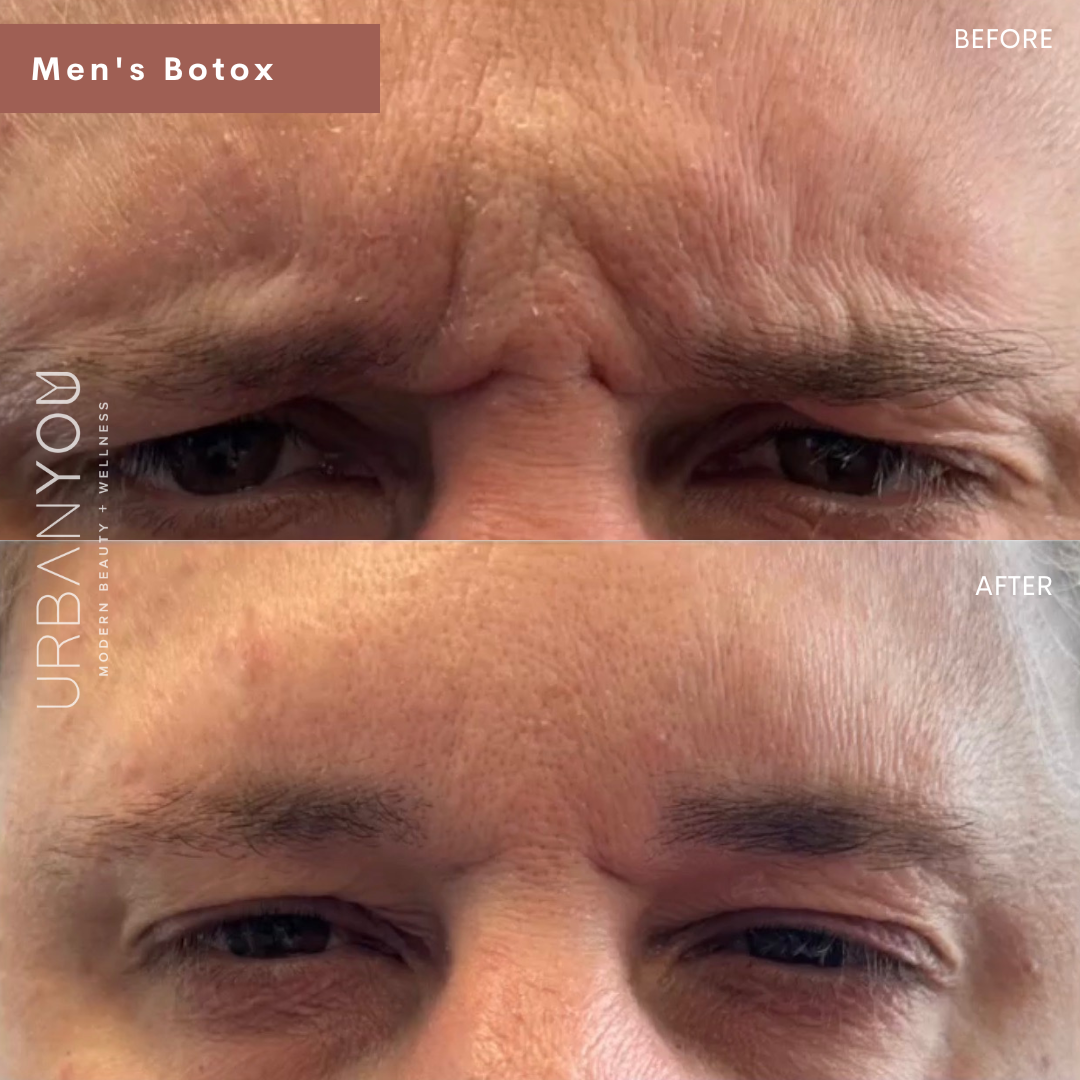 Brotox Botox For Men Cost Faq Side Effects — Urban You Modern