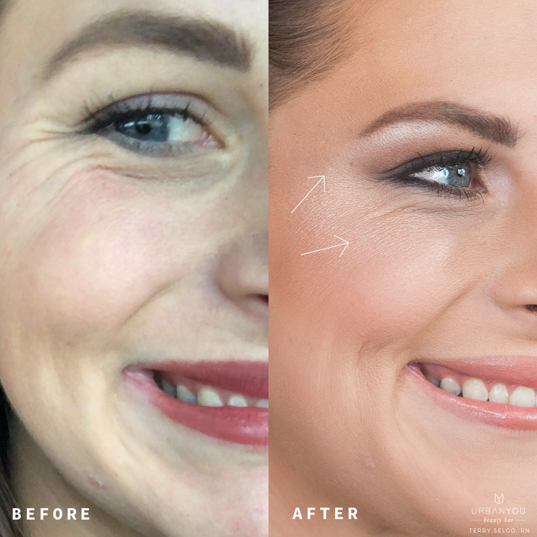 Botox for Midface — Urban You Med Spa