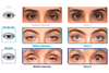 Get an Immediate Eyelid Lift Without Surgery — Urban You - Modern ...