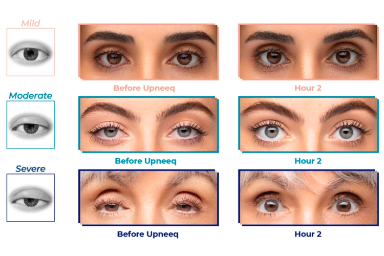Get an Immediate Eyelid Lift Without Surgery — Urban You - Modern Beauty + Wellness