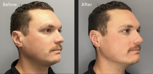 Jaw Filler for Men - Get a Sharp Jawline with Juvéderm Volux — Urban ...