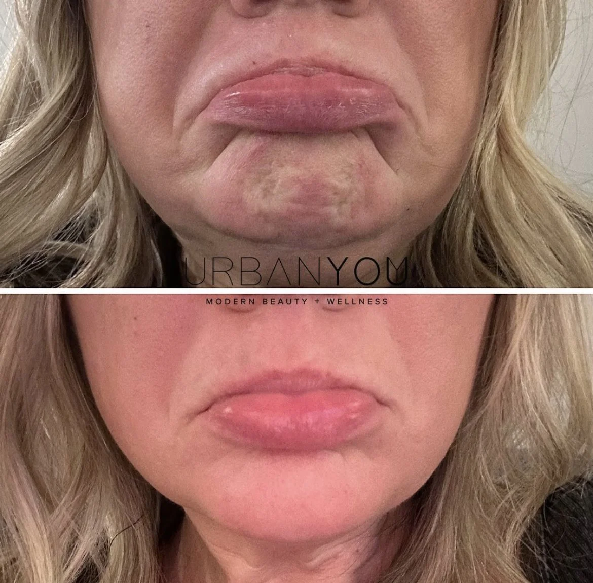 Botox for Lower Face — Urban You Med Spa