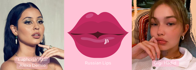 Russian Lips: Cost, Side Effects, Before and After, + More! — Urban You ...