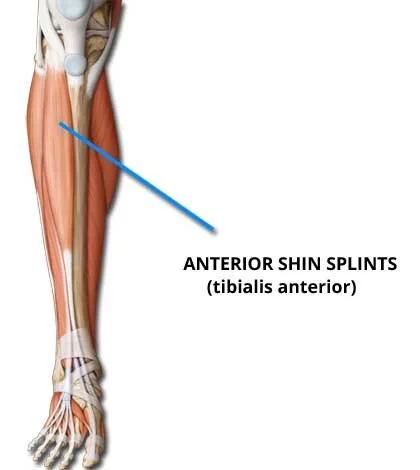 Types Of Shin Splints