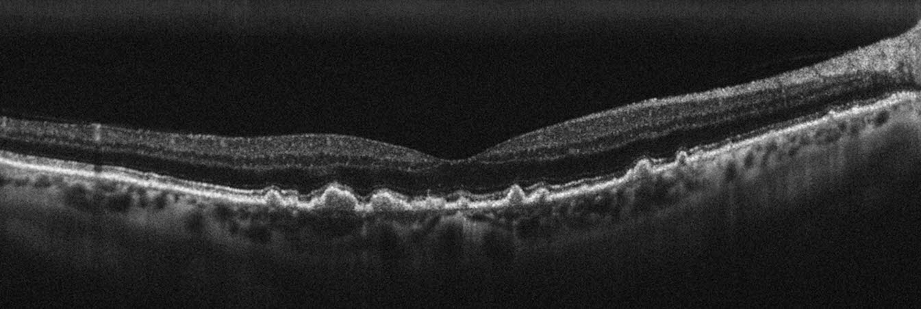 Bay Eye Care — Glaucoma and Retinal Disease