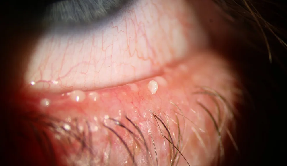 Bay Eye Care — Lipiflow for Dry Eye