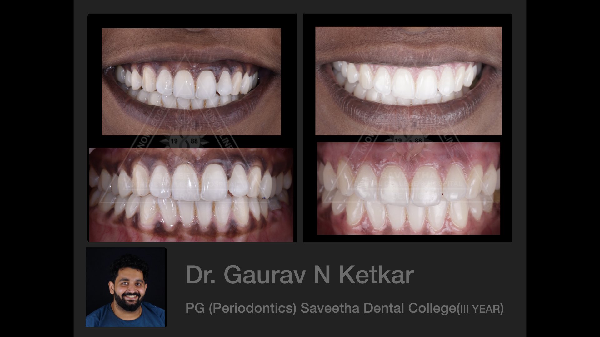 Gingival Depigmentation — Periodontics @ Saveetha