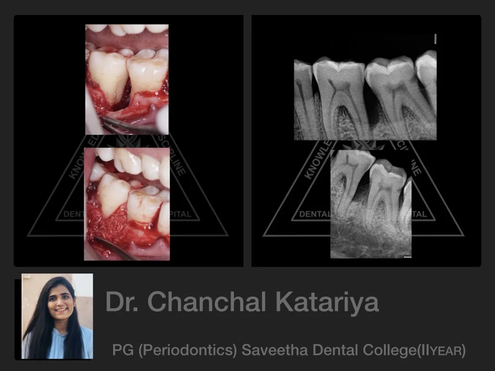Regenerative periodontal therapy using Osseograft (Xenograft) and GTR ...