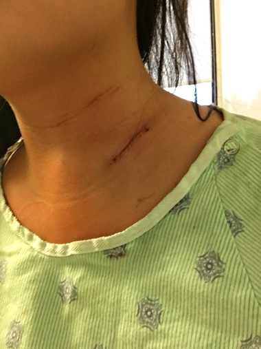 Neck Lymph Node Biopsy