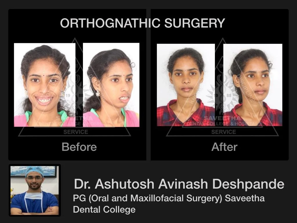 Maxillary Prognathism Correction