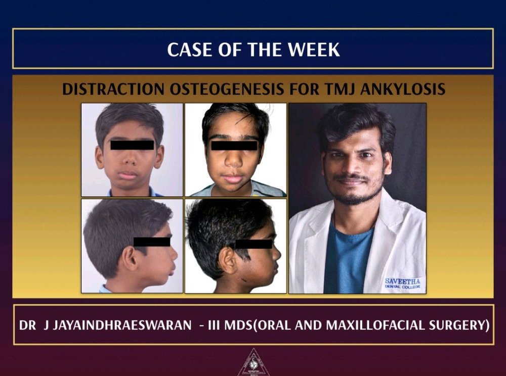 Best Case of The Week - Mandibular Distraction Osteogenesis — Oral & Maxillofacial Surgery