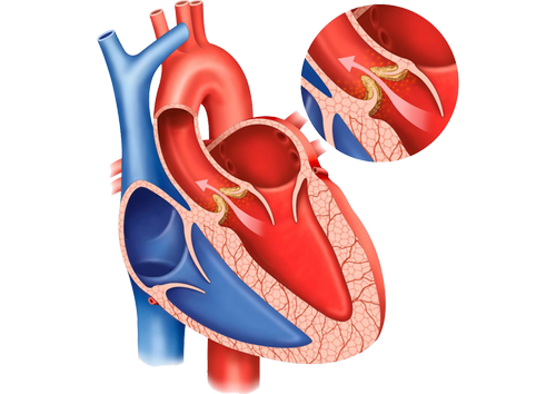 Aortic Stenosis — Malta Heart Foundation