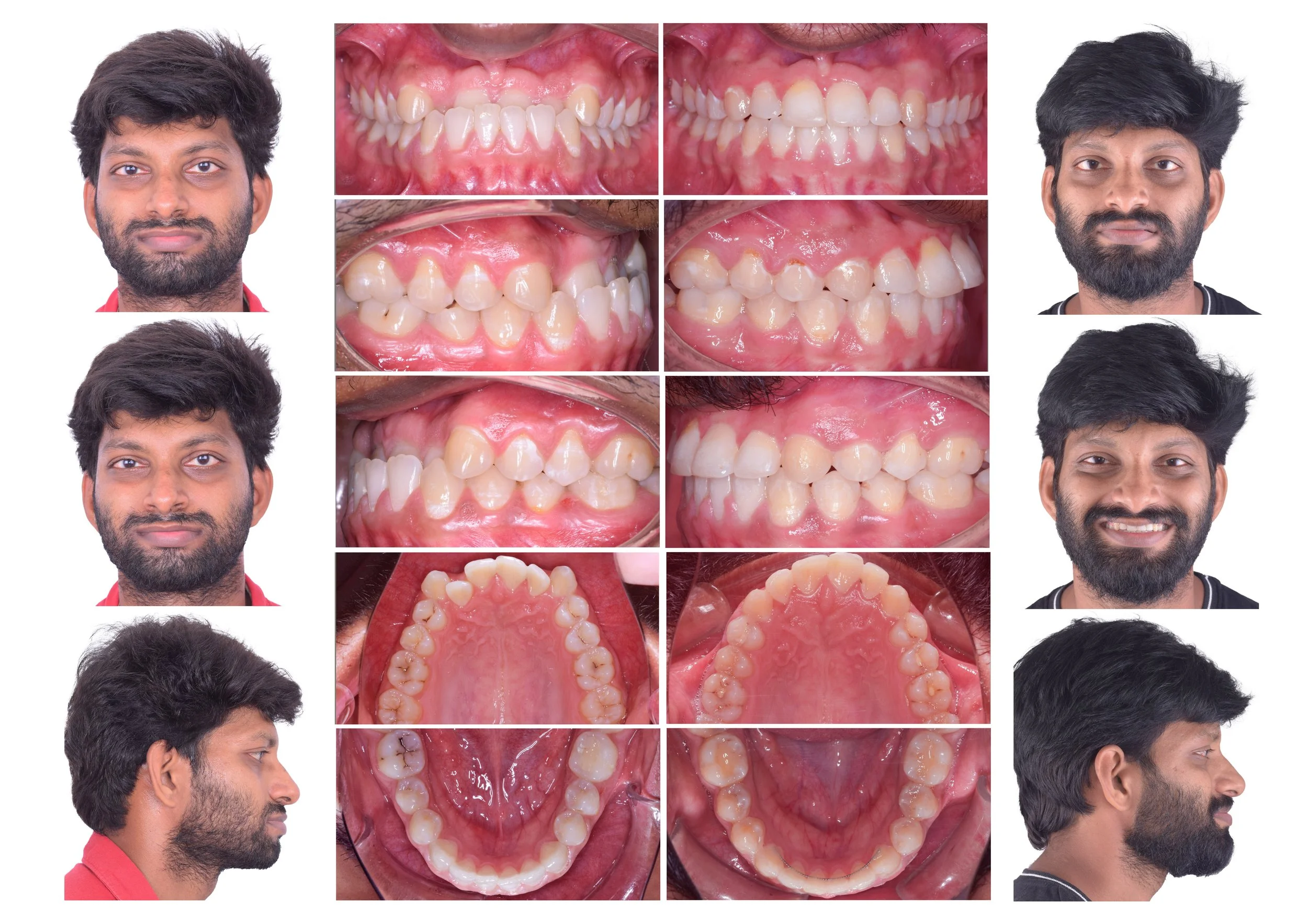 CORRECTION OF ANTERIOR CROSSBITE AND LOWER ANTERIOR PROTRUSION ...