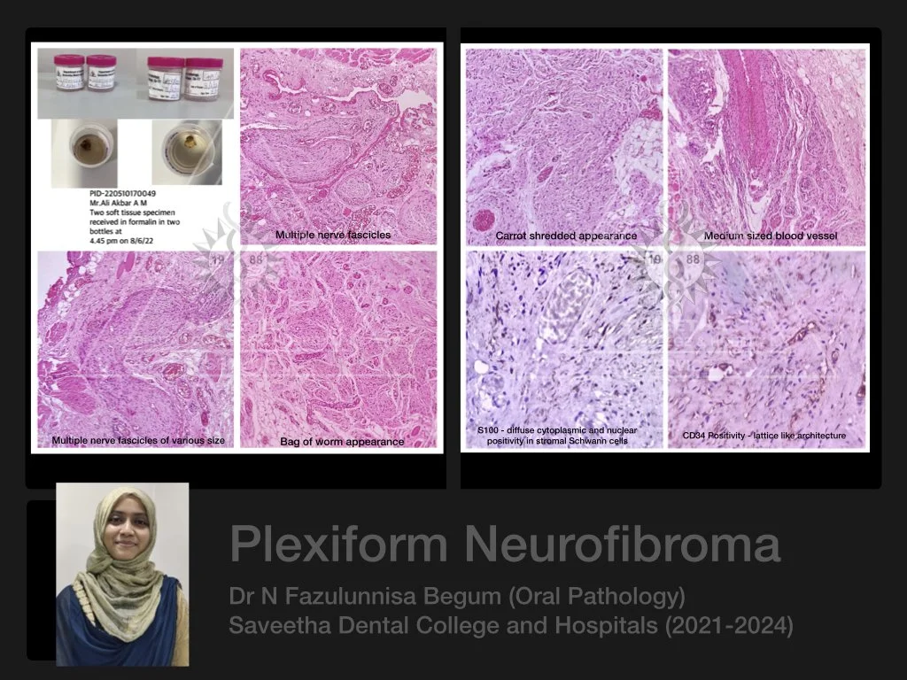 Plexiform Neurofibroma Histopathology