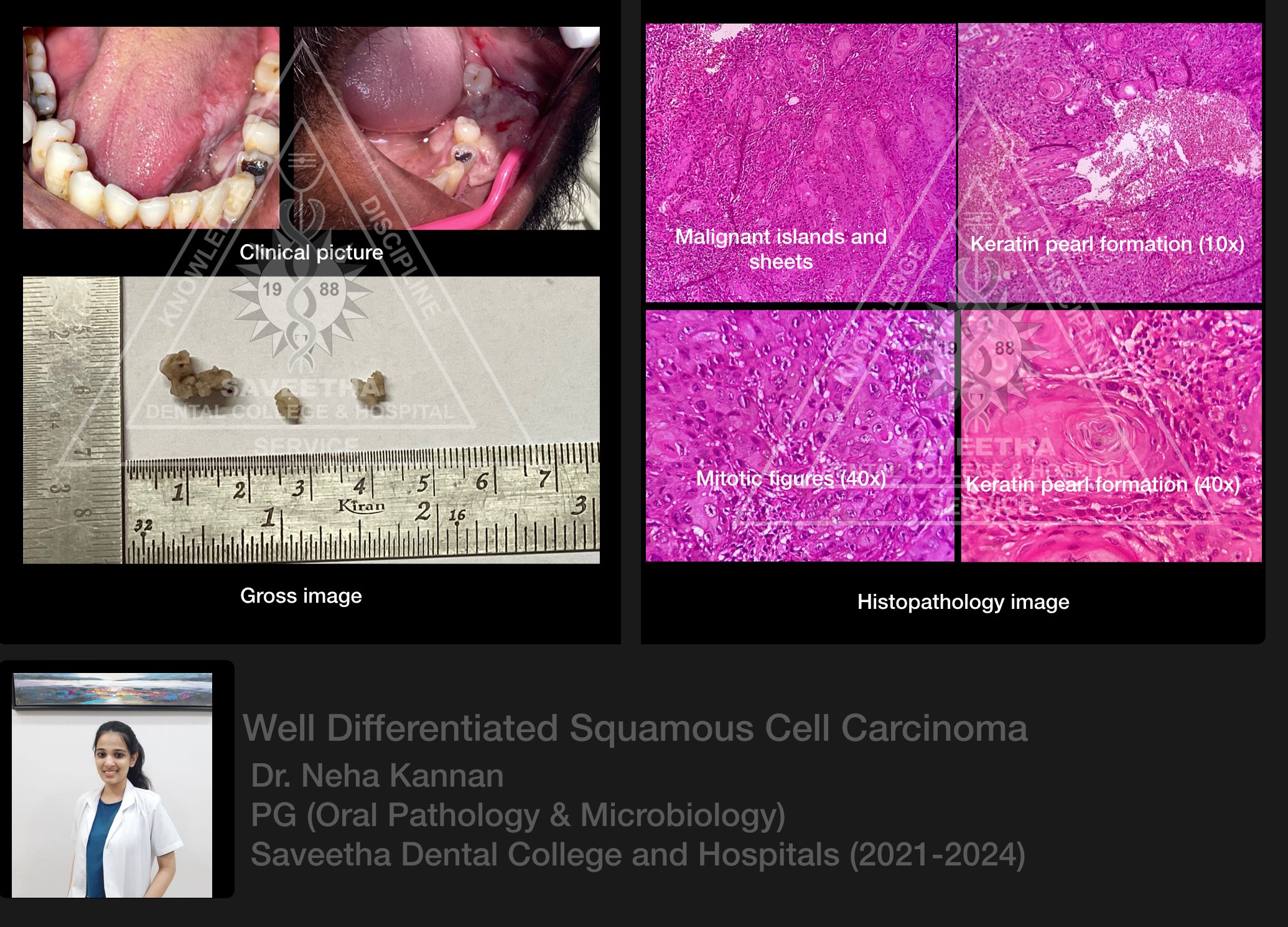 Well Differentiated Squamous Cell Carcinoma — Oral Pathology Saveetha