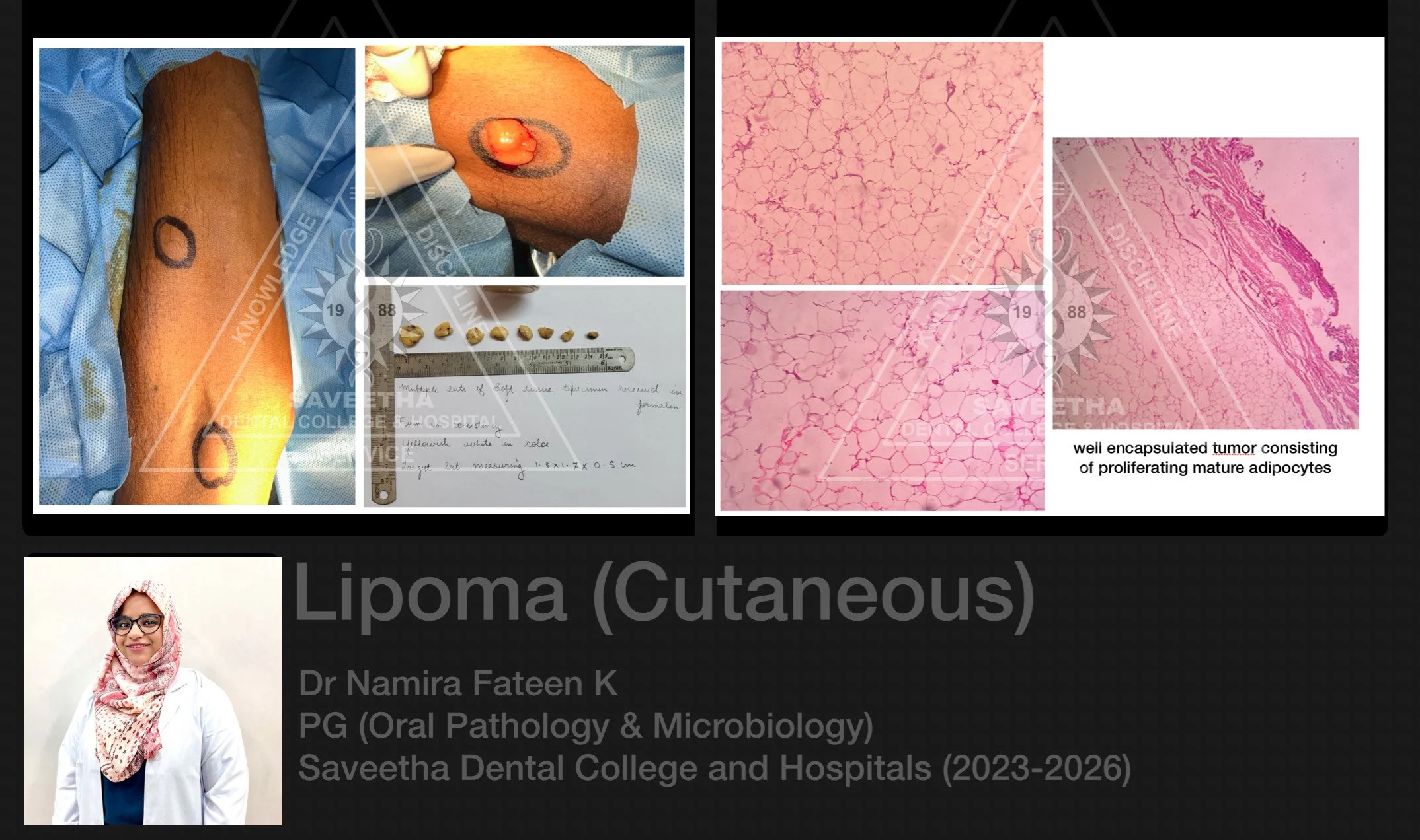 Lipoma ( Cutaneous ) — ORAL PATHOLOGY-SAVEETHA