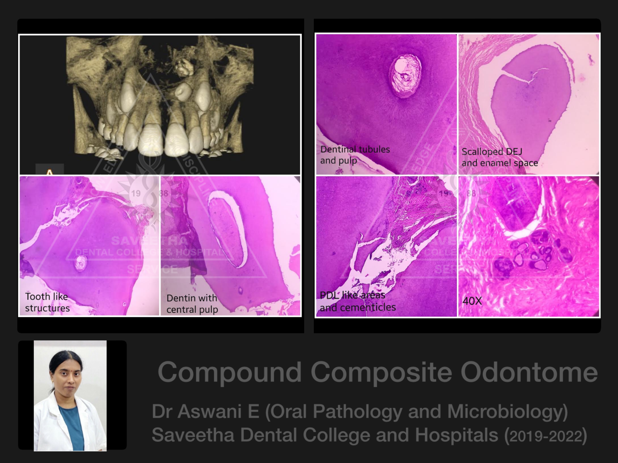 Compound Composite Odontome — ORAL PATHOLOGY-SAVEETHA