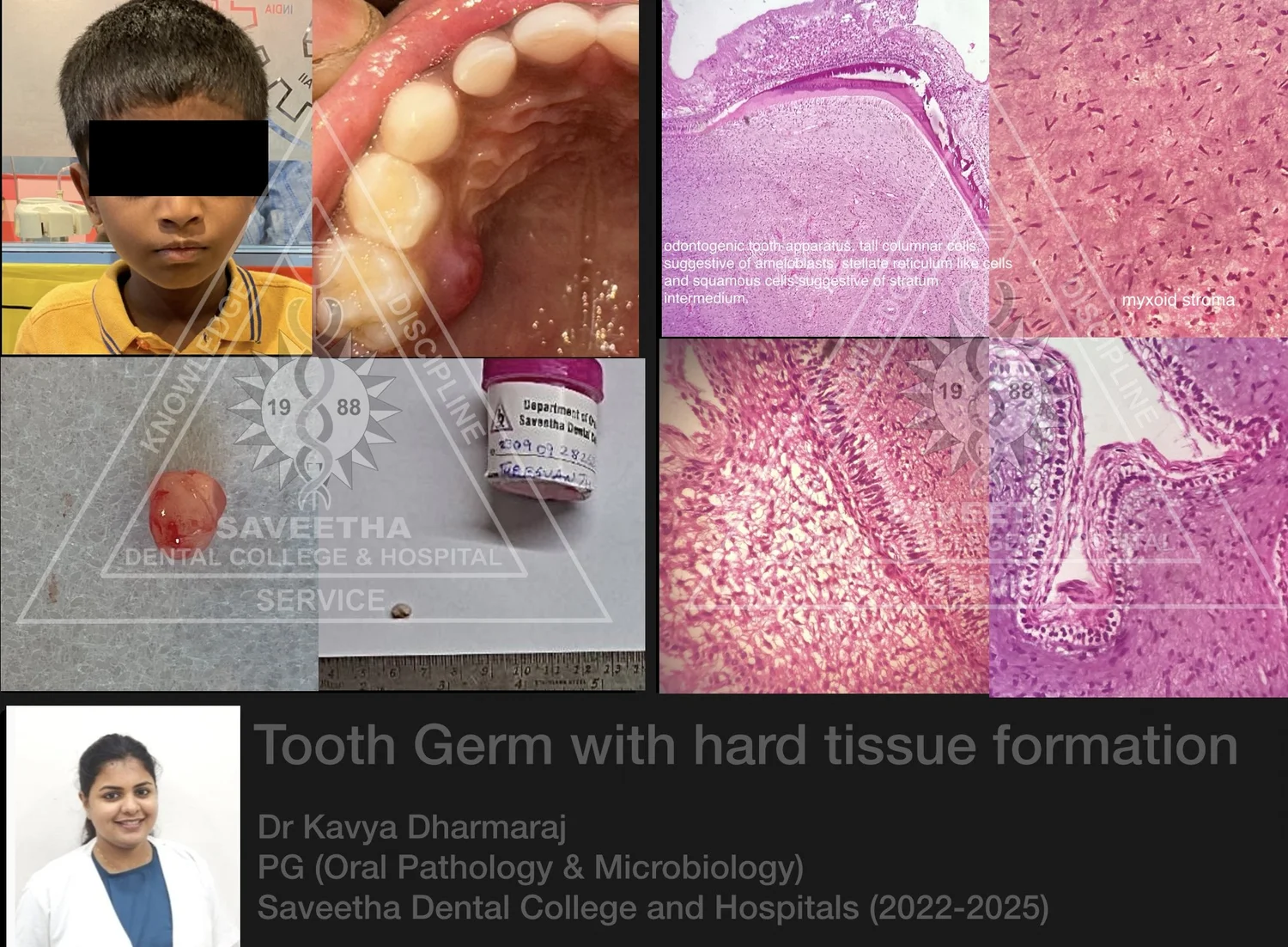 Tooth Germ with Hard tissue Formation — ORAL PATHOLOGY-SAVEETHA