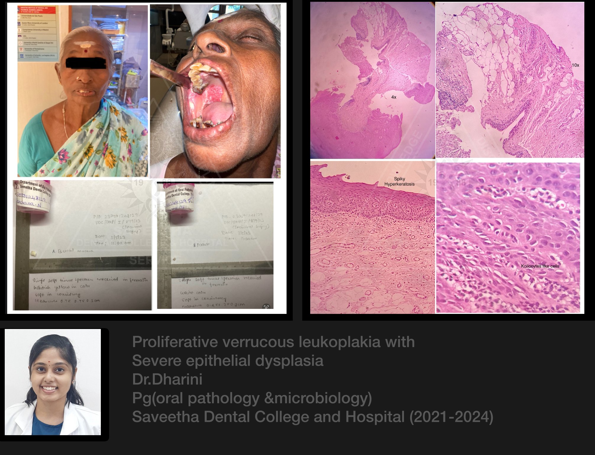 Proliferative Verrucous Leukoplakia Histology