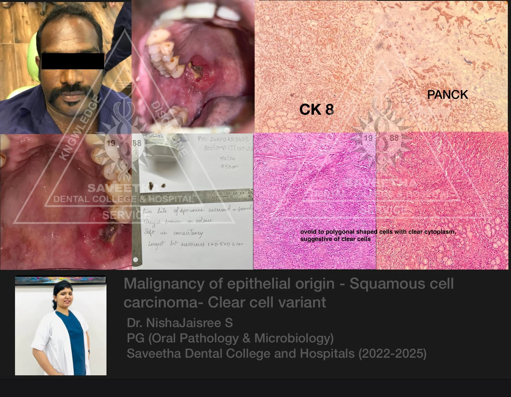 Malignancy of epithelial origin - Squamous cell carcinoma - Clear cell ...