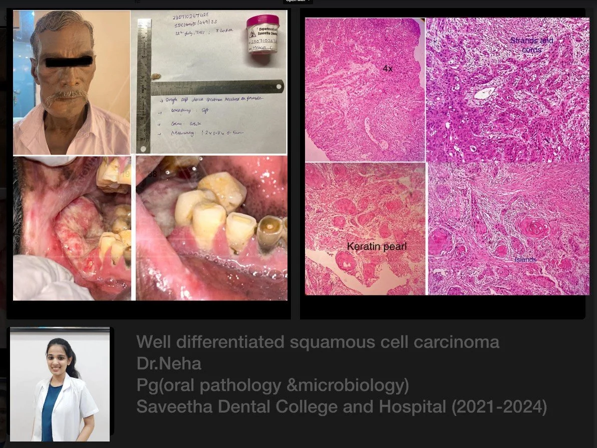 Well Differentiated Squamous Cell Carcinoma — ORAL PATHOLOGY-SAVEETHA