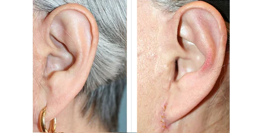 Earlobe Reduction and Repair in San Francisco Bay Area CA | San ...