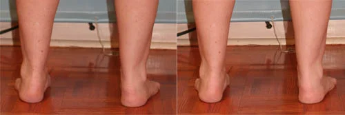 Ankle Liposuction | Usha Rajagopal, MD