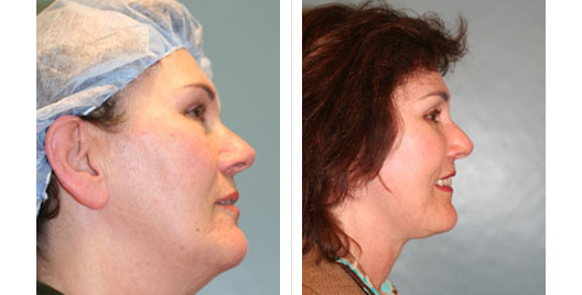 Monsplasty Before And After