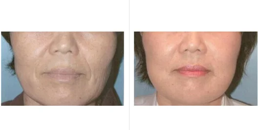 Monsplasty Before And After