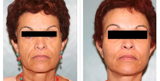 Monsplasty Before And After