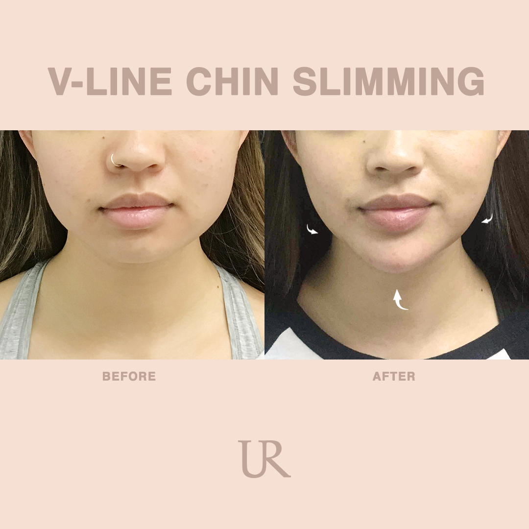 Tips for Getting a V-Shaped or V-Line Face Naturally (Without surgery or injections) | Usha ...