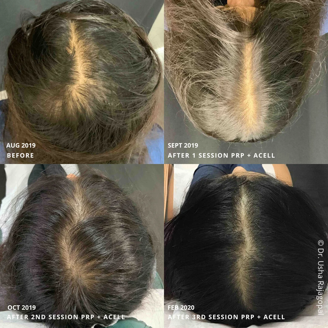 Hair Regrowth Therapy with ACell + PRP | San Francisco Bay Area | Usha ...