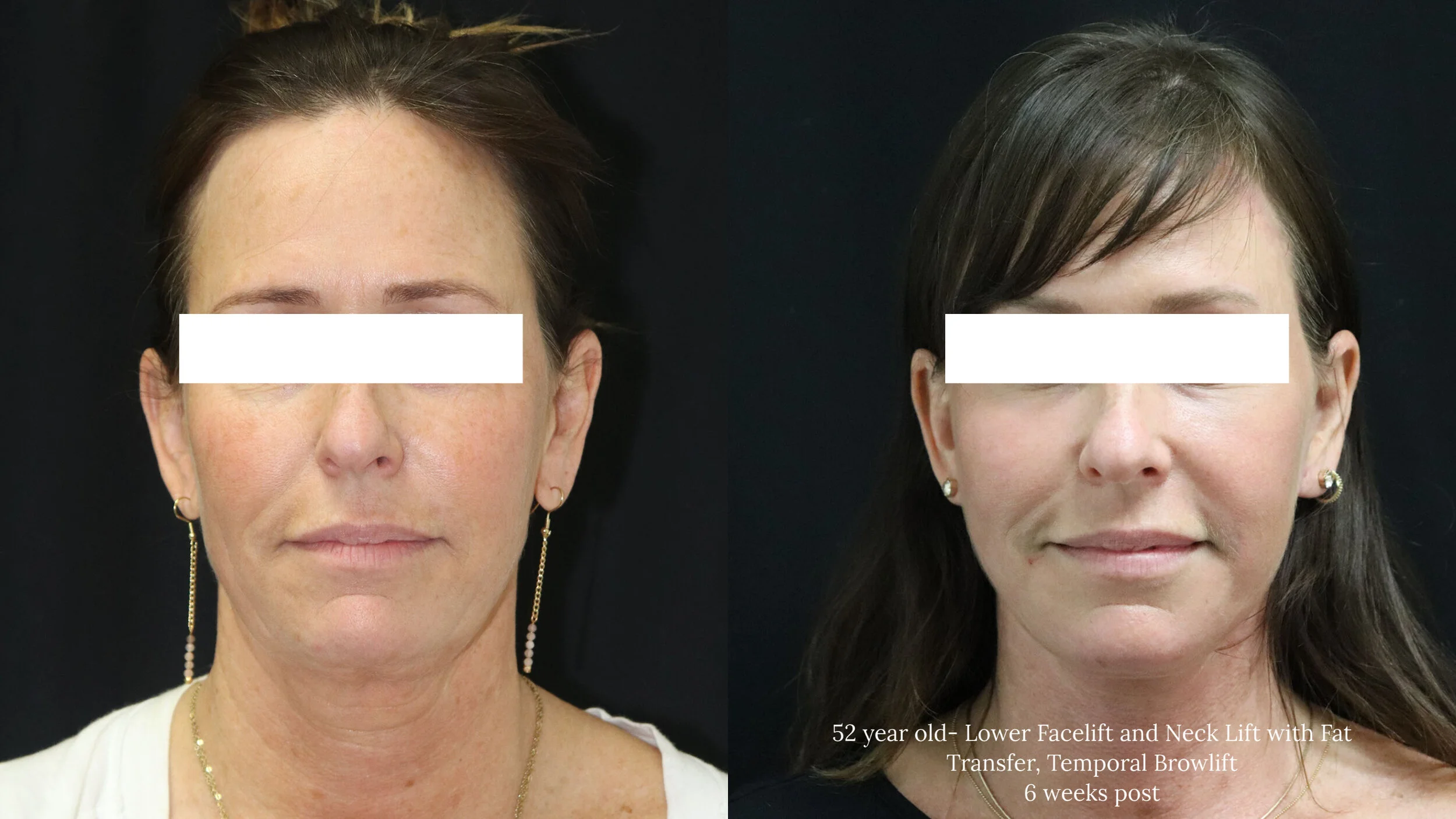 Face Lift in San Francisco Bay Area CA | San Francisco Plastic Surgery ...
