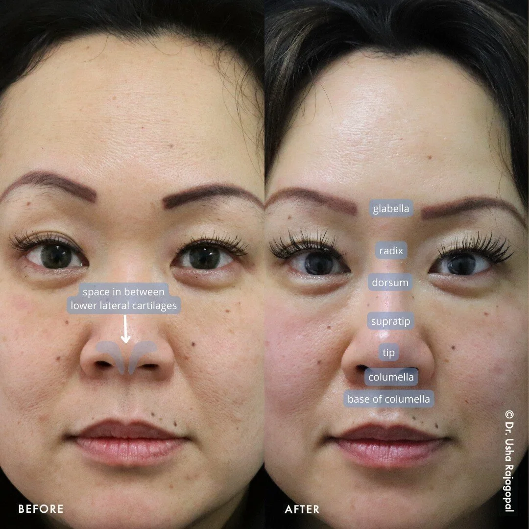 Bullhorn Lip Lift | Usha Rajagopal, MD