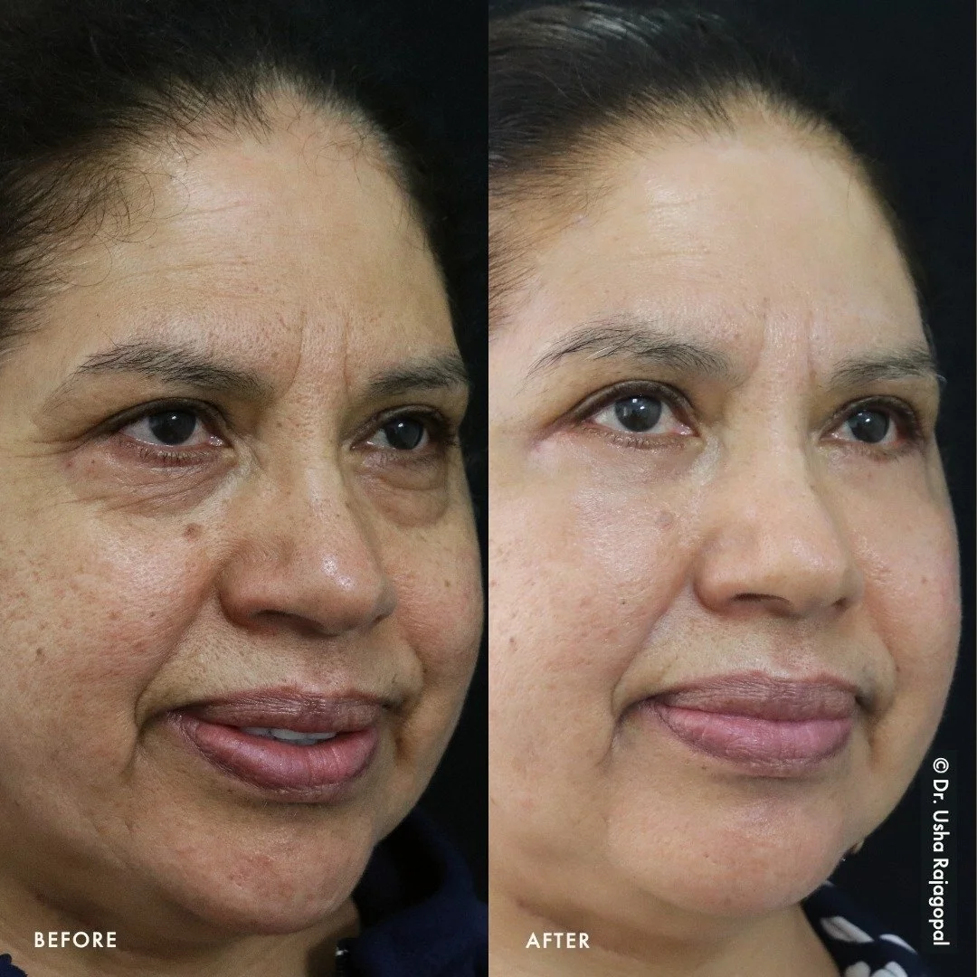 San Francisco Plastic Surgery & Laser Center | Usha Rajagopal, MD
