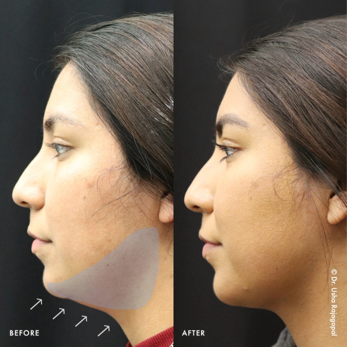 San Francisco Plastic Surgery & Laser Center | Usha Rajagopal, MD