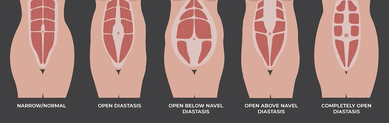 Physical Therapy — Diastasis Recti / Abdominal Separation