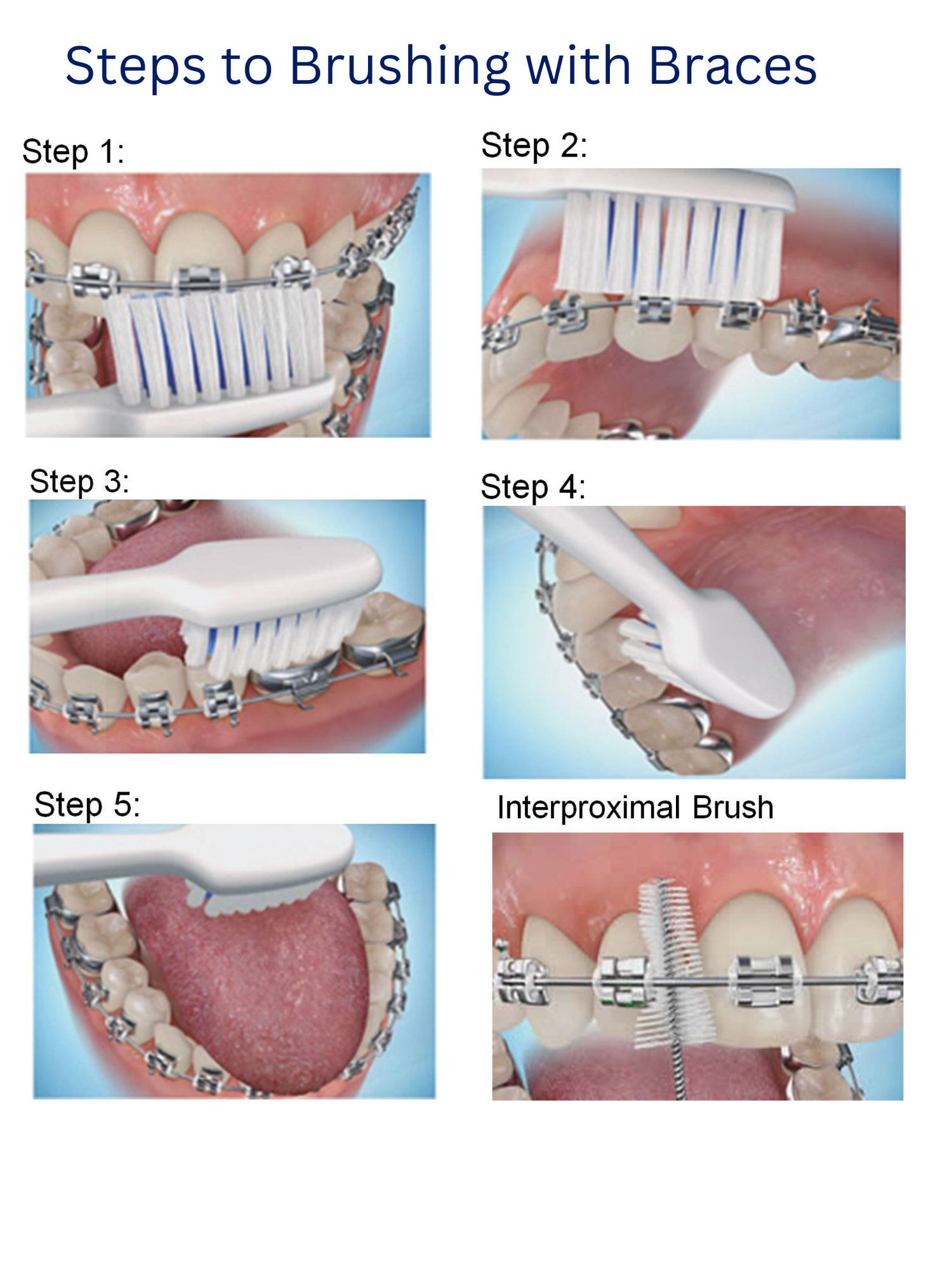 Brushing with Braces — Moore Orthodontics Affordable Orthodontist Lake Zurich