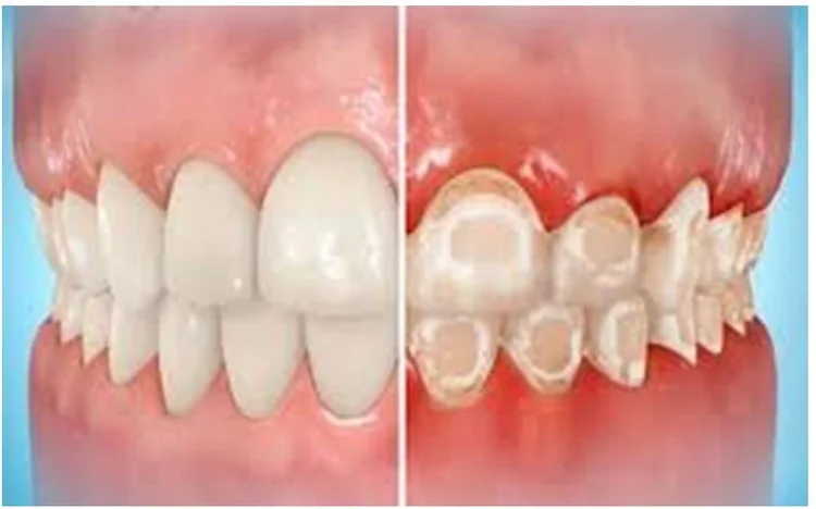 Taking Care of Braces — Moore Orthodontics Affordable Orthodontist Lake Zurich