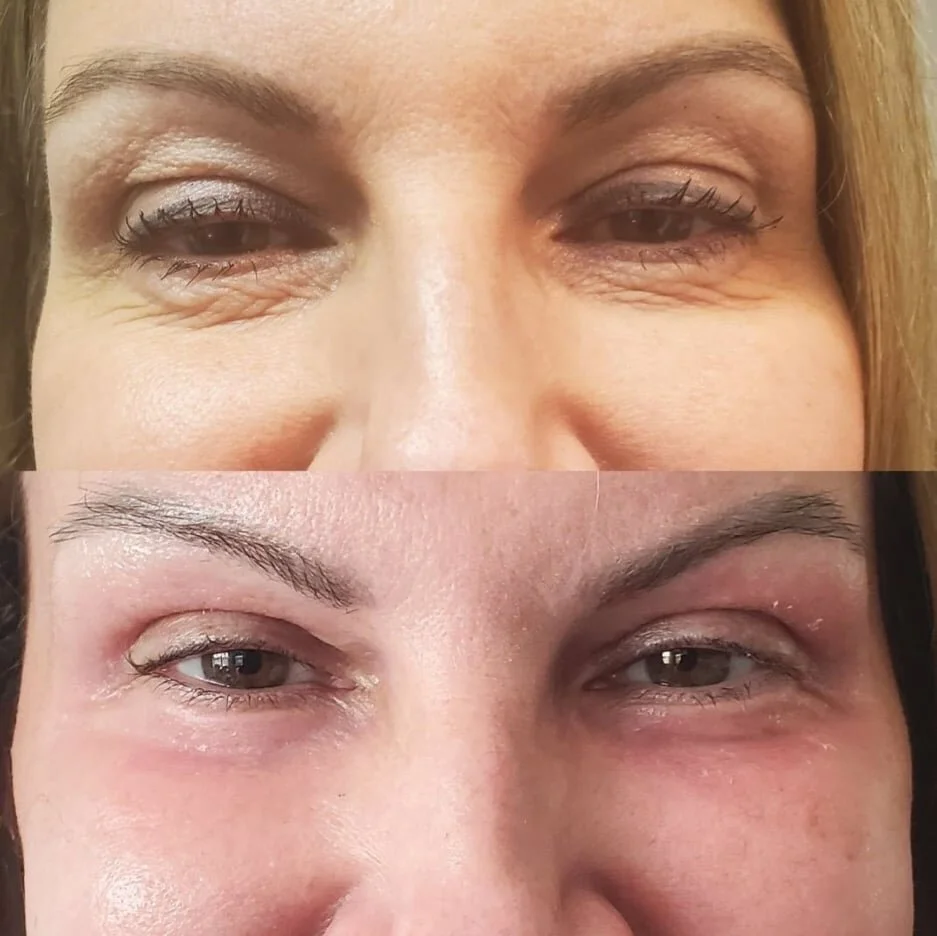 CO2 Laser West Palm Beach E Aesthetics CO2 Laser West Palm Beach E Aesthetics