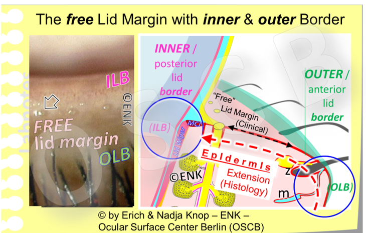 OVERVIEW of ... the Lid Margin — Ocular Surface Center Berlin