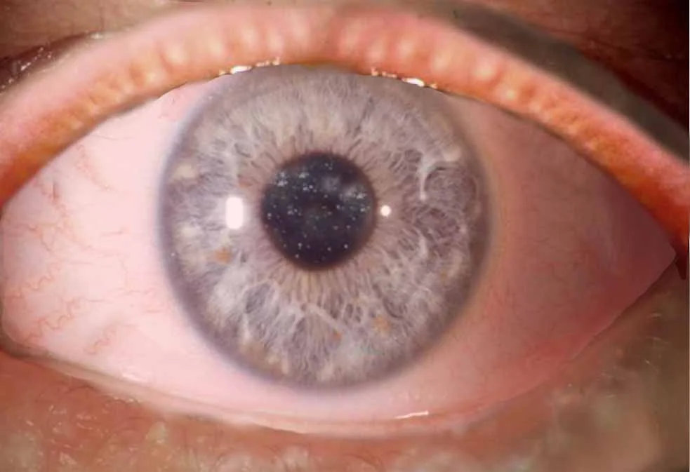 Glimpse On Dry Eye Disease — Ocular Surface Center Berlin