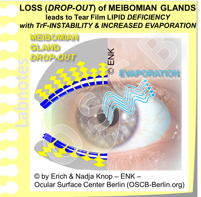 GLIMPSE on ... MGD — Ocular Surface Center Berlin