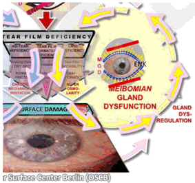GLIMPSE on ... MGD — Ocular Surface Center Berlin