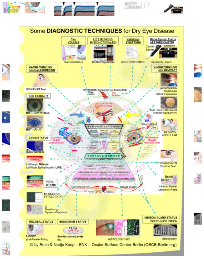 GLIMPSE on ... Dry Eye Disease — Ocular Surface Center Berlin