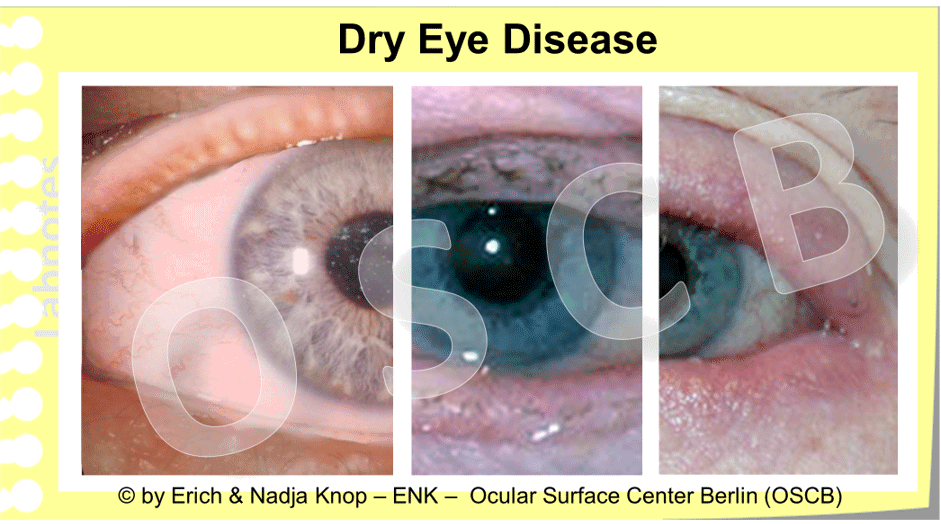 GLIMPSE on ... Dry Eye Disease — Ocular Surface Center Berlin