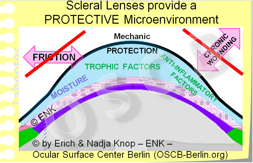 Scleral Contact Lenses — Ocular Surface Center Berlin