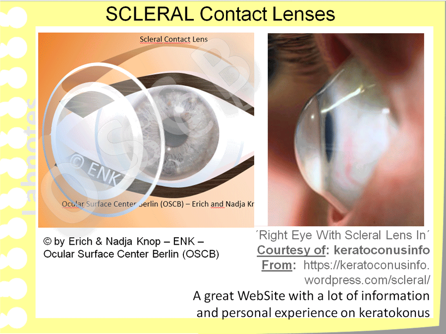 OVERVIEW of Contact Lenses — Ocular Surface Center Berlin