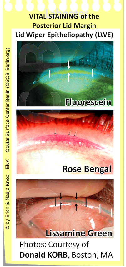 OVERVIEW of Contact Lenses — Ocular Surface Center Berlin